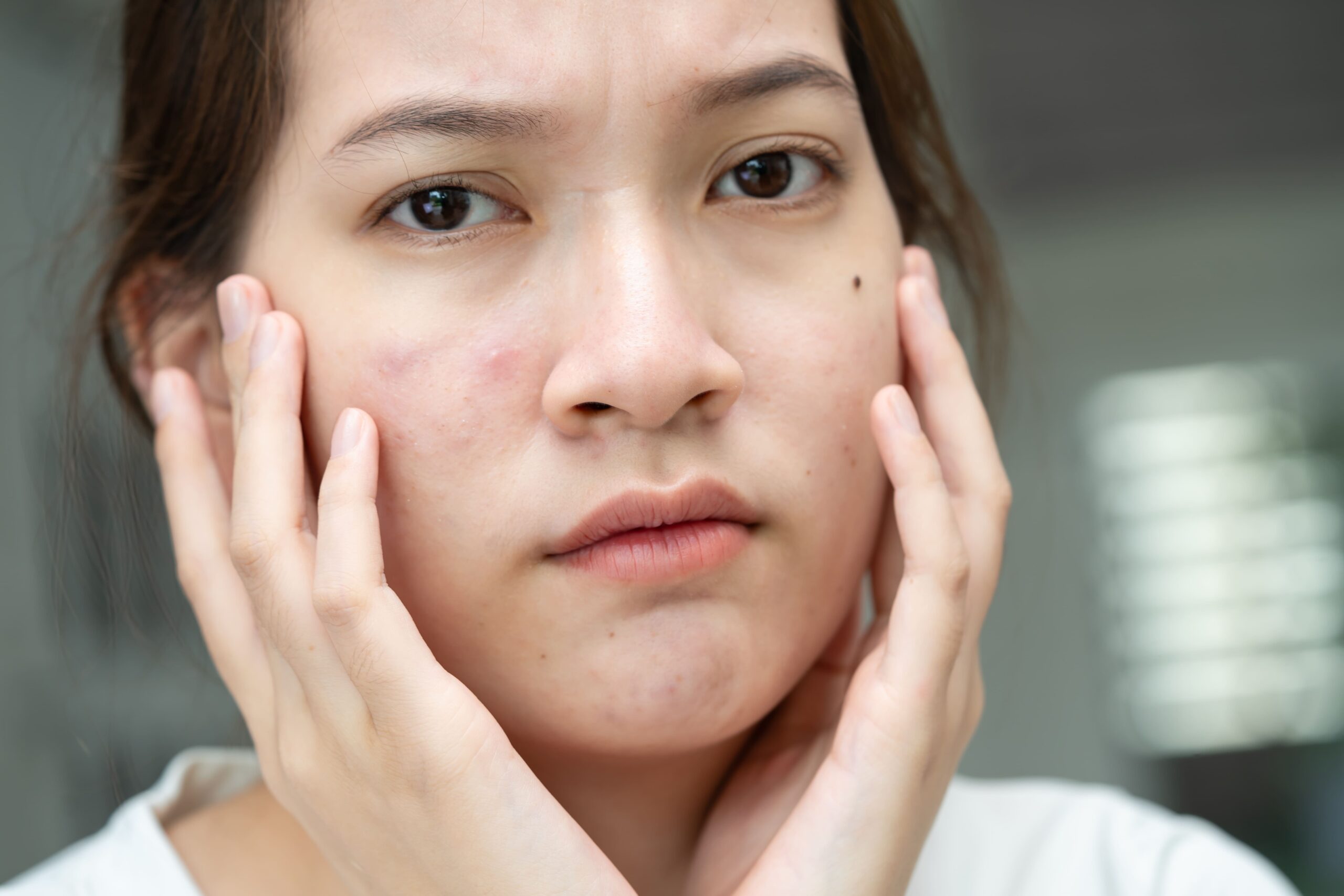 Acne Treatment in Singapore