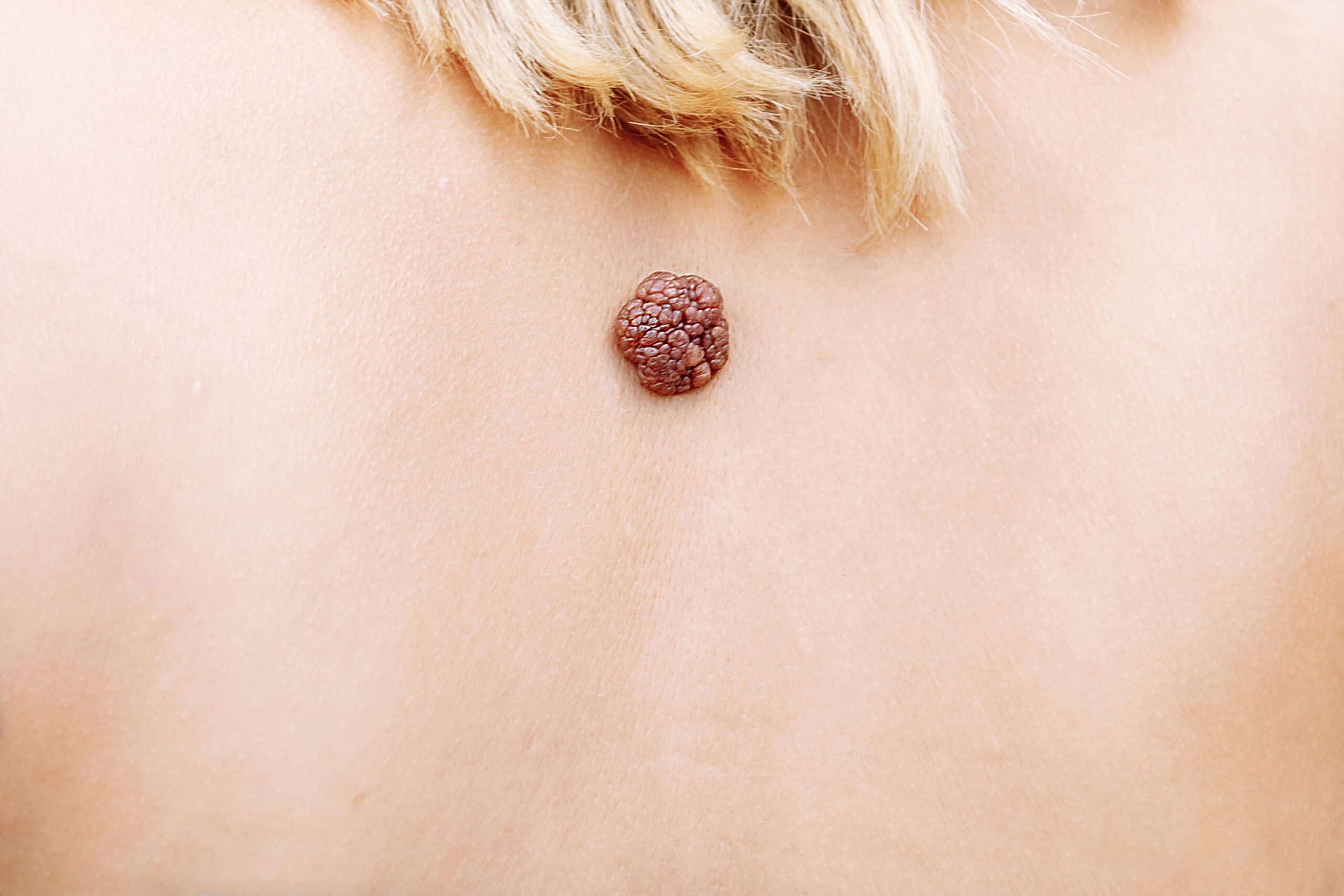 Skin Cancer Surgery Singapore | Dermatology Care