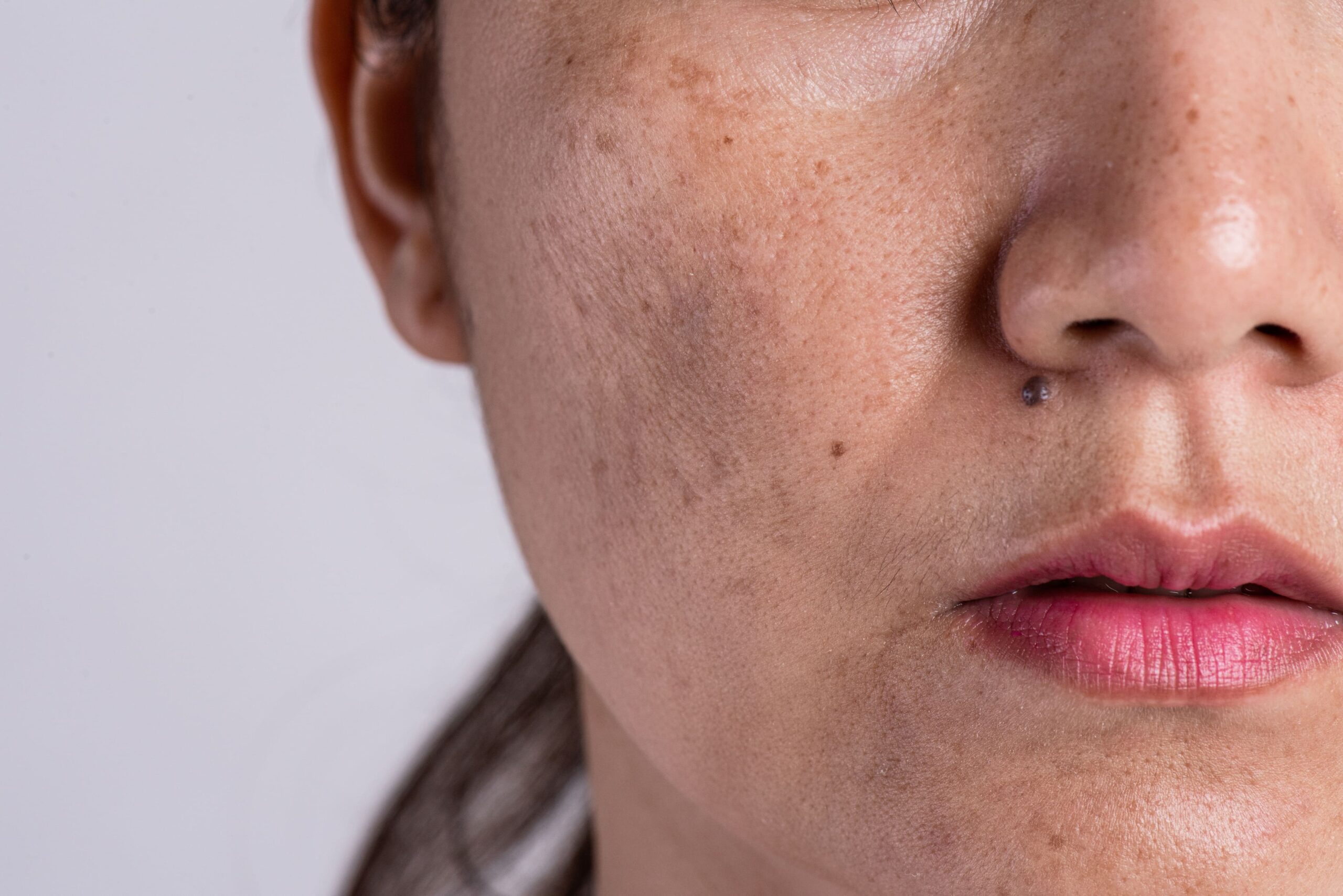Pigmentation Treatment | Singapore Dermatology Treatment