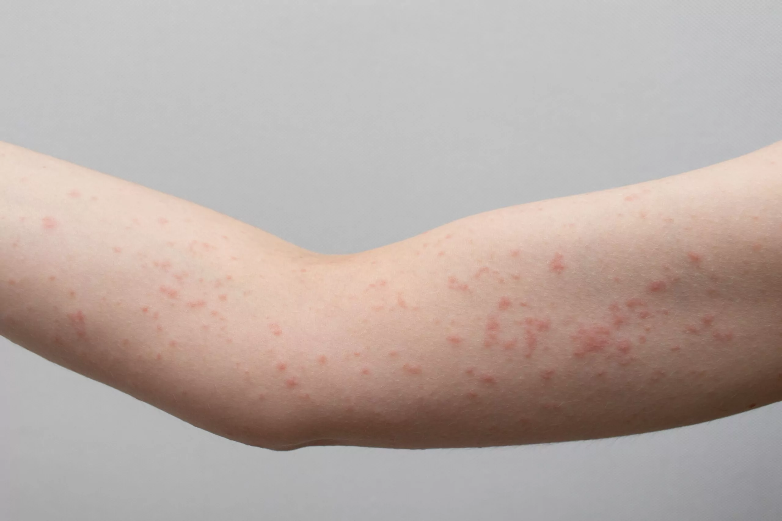 What Triggers Hives? A Comprehensive Guide - The Skin Drs.